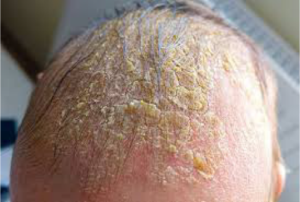 Is Your Baby’s Rash Normal? | Families First Pediatrics