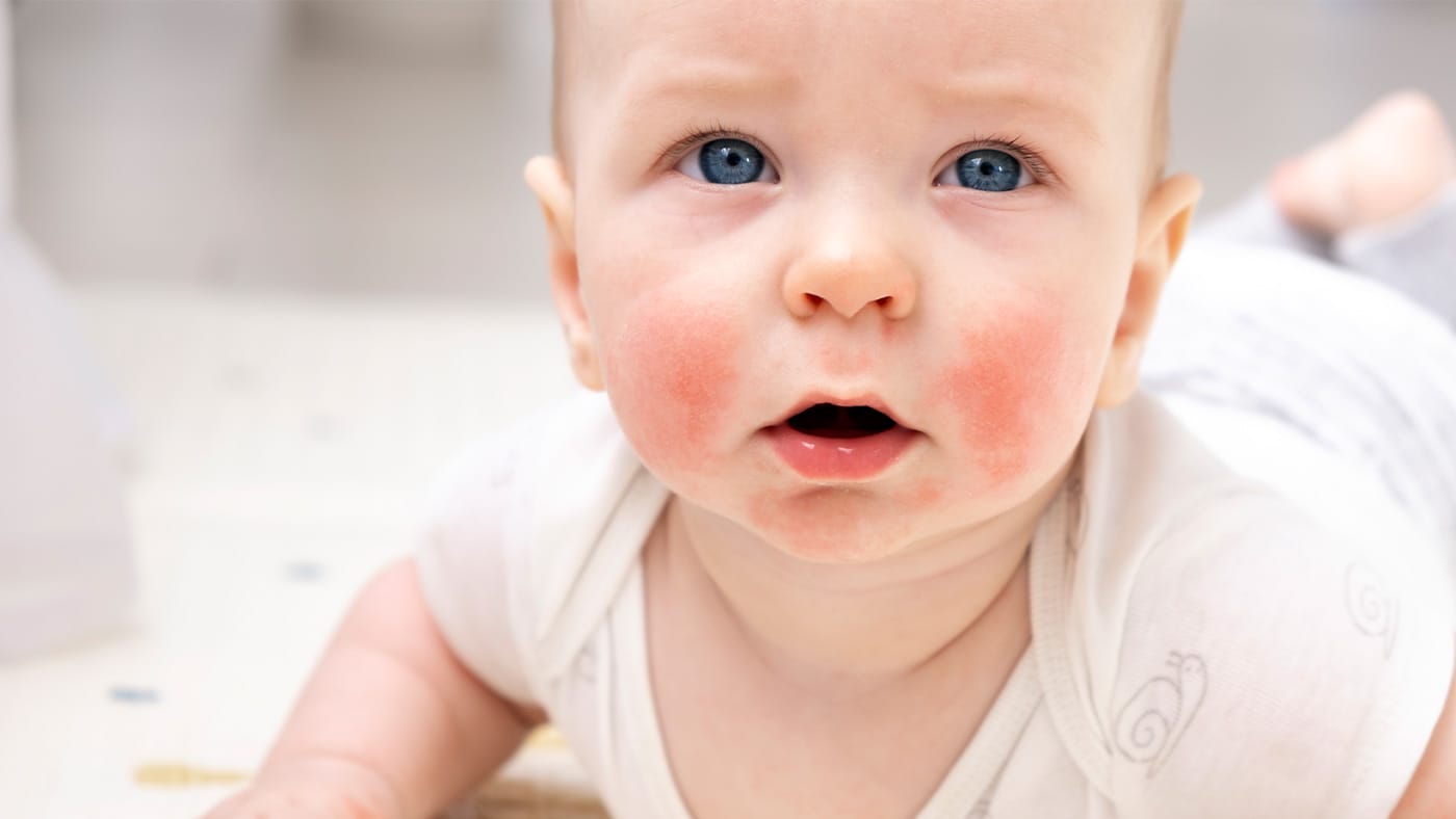 Baby Eczema Rash Baby Eczema Rash