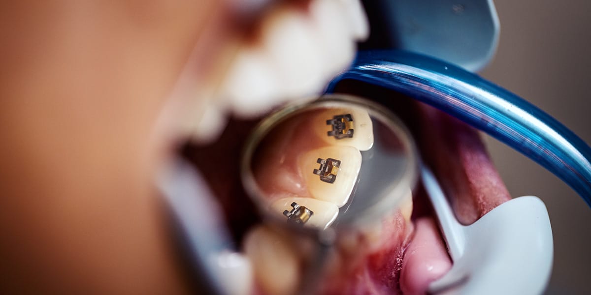 Lingual Braces | Families First Pediatrics