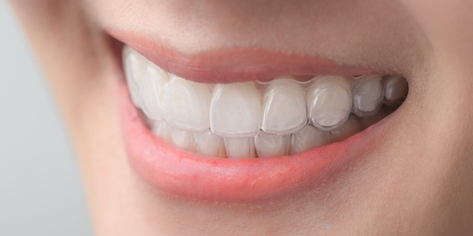 Clarity Advanced Clear Braces | Families First Orthodontics